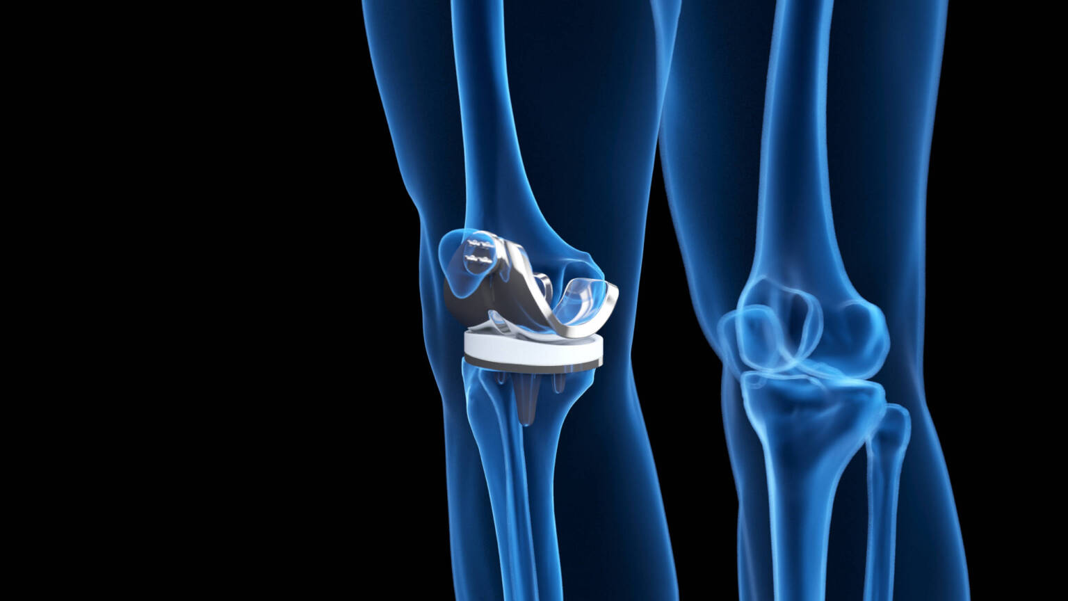 Keratin/bio-MOF coating protects bioresorbable bone implants - European ...