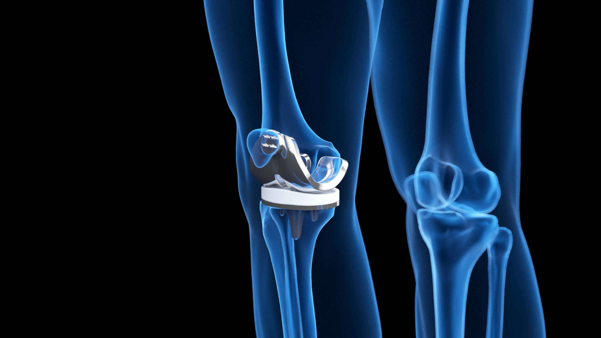 Keratin/bio-MOF coating protects bioresorbable bone implants - European ...